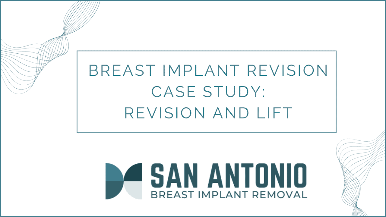 Breast Implant Revision Case Study: Augmentation Revision and Lift